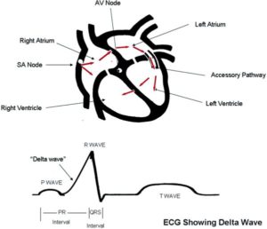Wolff-Parkinson-White Syndrome (WPW) – Paces